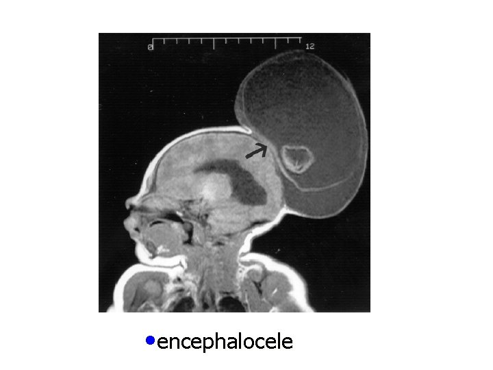 CONGENITAL ABNORMALITIES OF CENTRAL NERVOUS SYSTEM The incidence