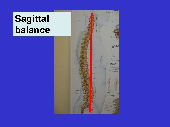 Sagittal balance Sagittal disbalance 180 Sagittal index JP
