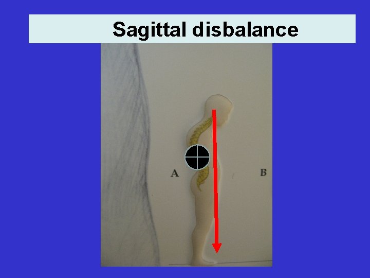 Sagittal balance Sagittal disbalance 180 Sagittal index JP