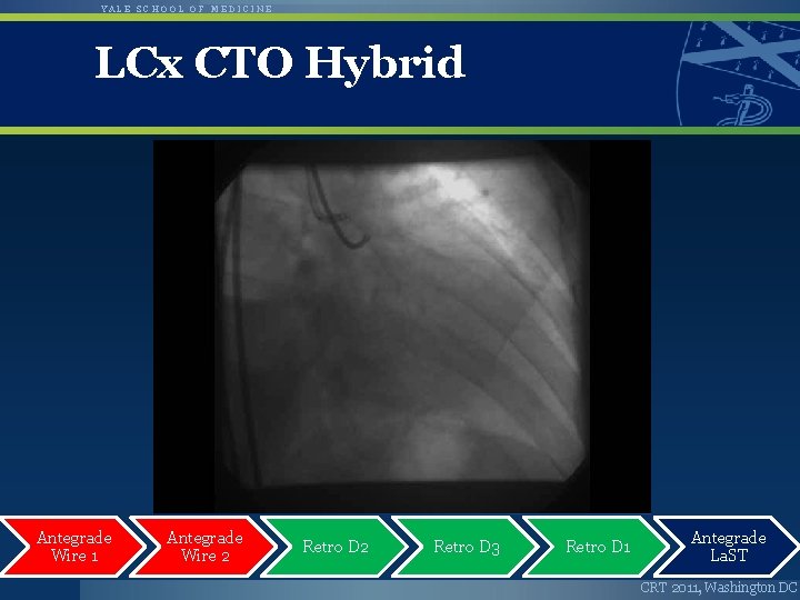 The Spectrum of Guidewires Available to Recanalize CTO