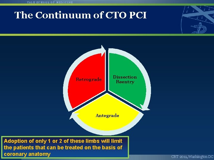 The Spectrum of Guidewires Available to Recanalize CTO