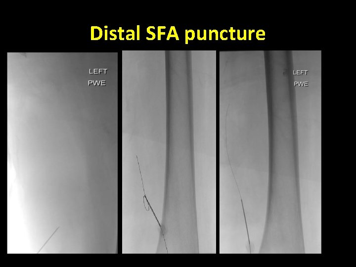 Direct access of the SFA step by step