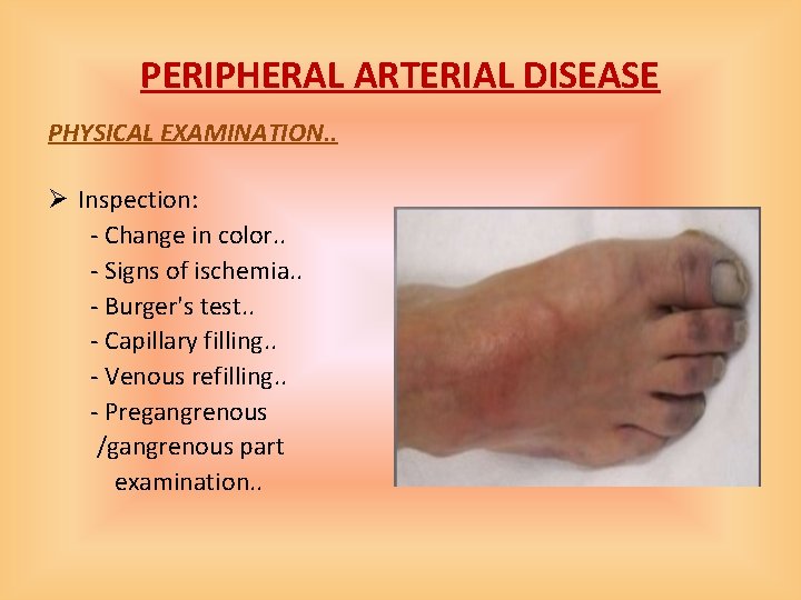 ATHEROSCLEROSIS PAD CAROTID STENOSIS ACUTE LIMB ISCHEMIA Dr