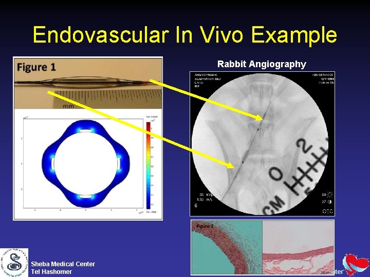 Novel Transcatheter Device to Treat Hypertrophic Obstructive Cardiomyopathy