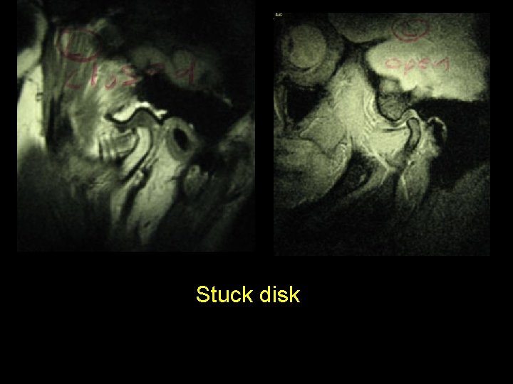 Internal Derangement of the Temporomandibular Joint Rosalyn Cheng
