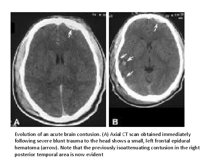 CNS TRAUMA PART II BY DR PAVAN KUMAR