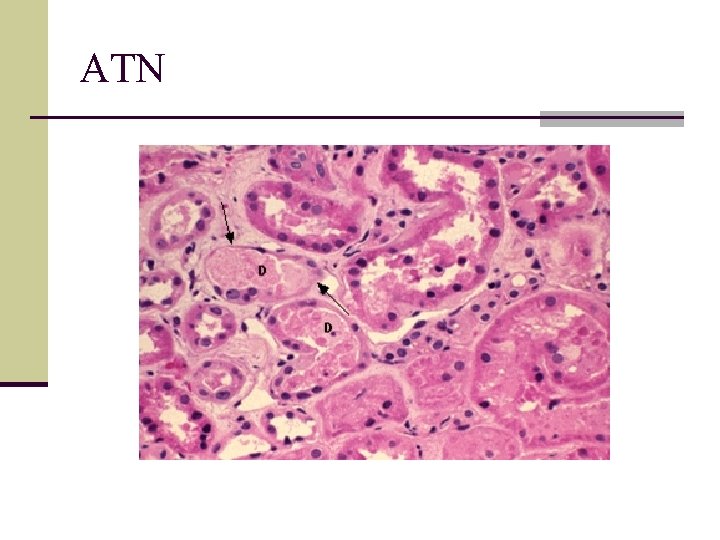 Acut and chronic renal failure Tams Bense MD