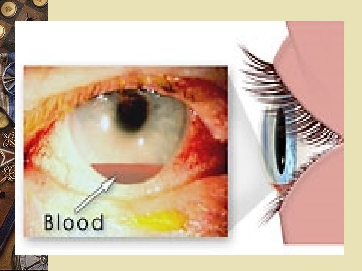Hyphema Presented by Dr Aina A S Outline