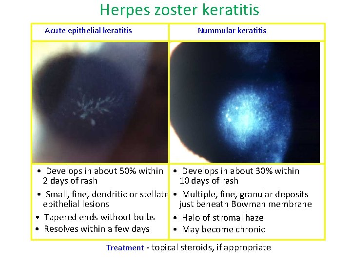 NON ULCERATIVE SUPERFICIAL KERATITIS Dr VIVEKANAND U Herpes