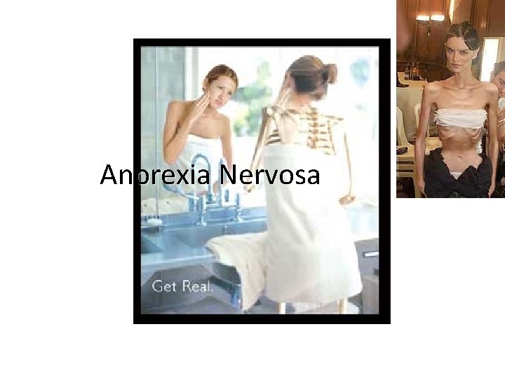 Anorexia Nervosa Eating Disorders The main two types