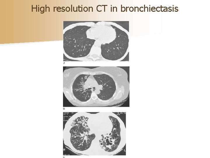 Suppurative lung syndromes Bronchiectasis Definition Acquired abnormal ...