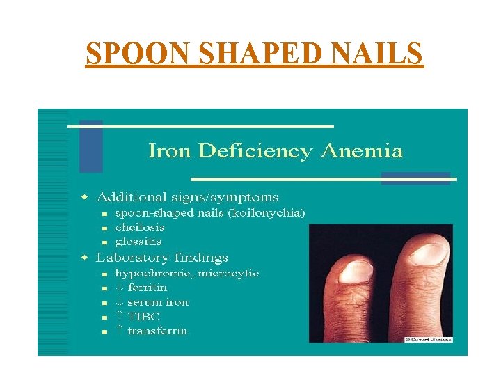 ANEMIA BY Mrs PARIMALA SRIDHARAN K V G