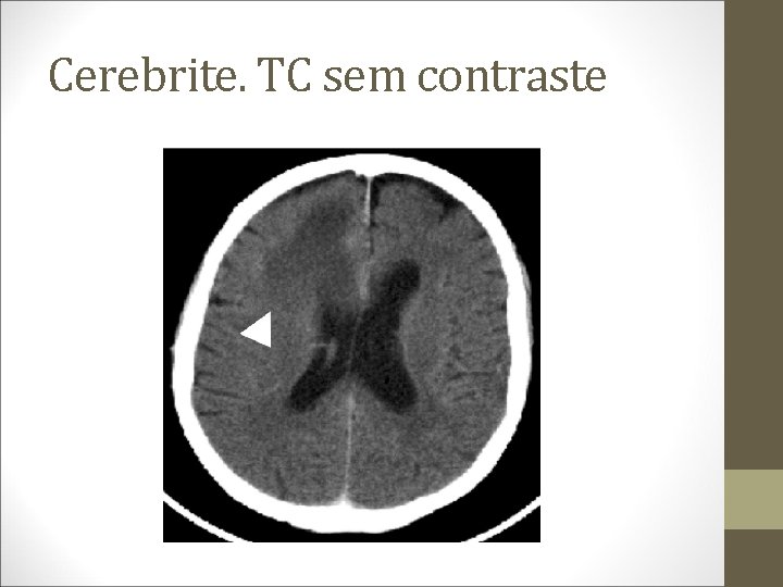 Abscesso cerebral Diagnstico e tratamento Apresentadora Aissa Rodriguez