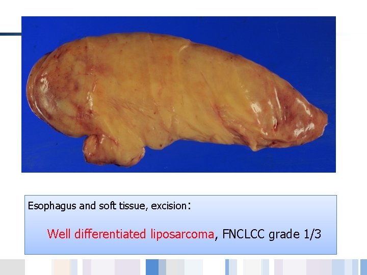 CASE 1 M70 C C dyspnea PHx sp