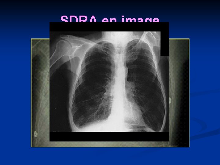 Prise en charge dun patient en SDRA par