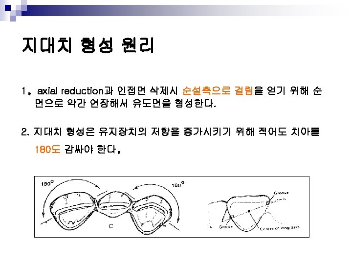 ResinBonded Fixed Partial Denture n n Rochette Bridge