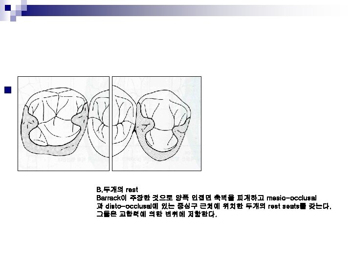 ResinBonded Fixed Partial Denture n n Rochette Bridge