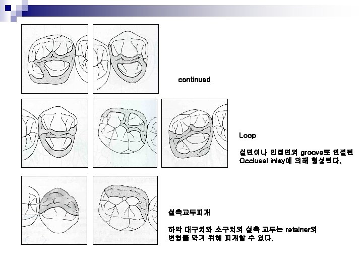 ResinBonded Fixed Partial Denture n n Rochette Bridge
