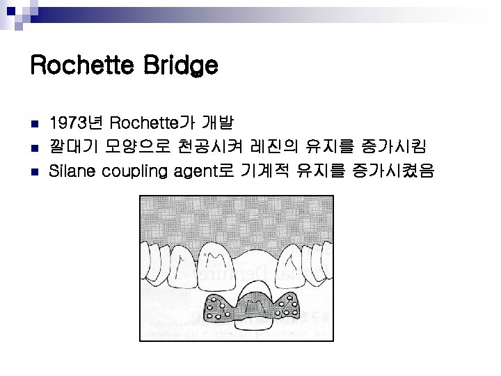 ResinBonded Fixed Partial Denture n n Rochette Bridge