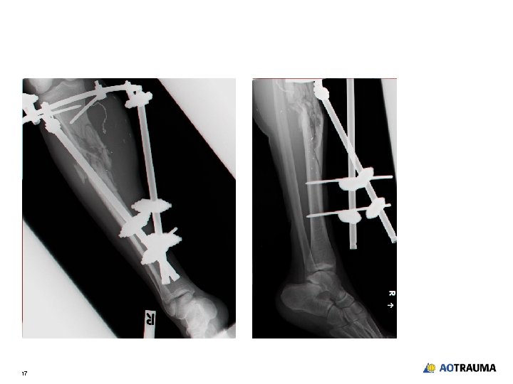 Highenergy gunshot wound to tibia Case History 2