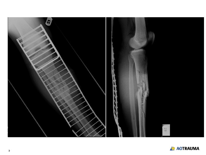 Highenergy gunshot wound to tibia Case History 2