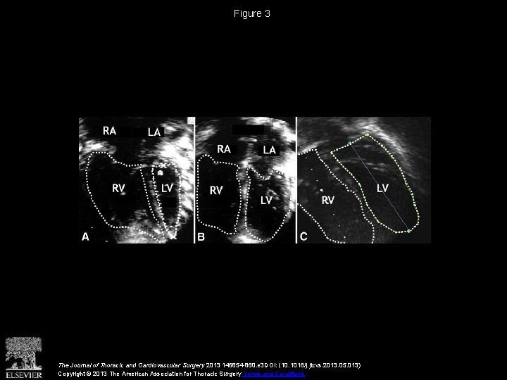 Twoventricle repairs in the unbalanced atrioventricular canal defect