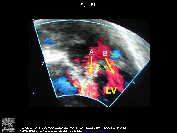 Twoventricle repairs in the unbalanced atrioventricular canal defect