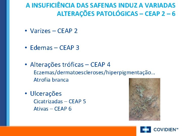 Abordagem do paciente com insuficincia avanada da Safena