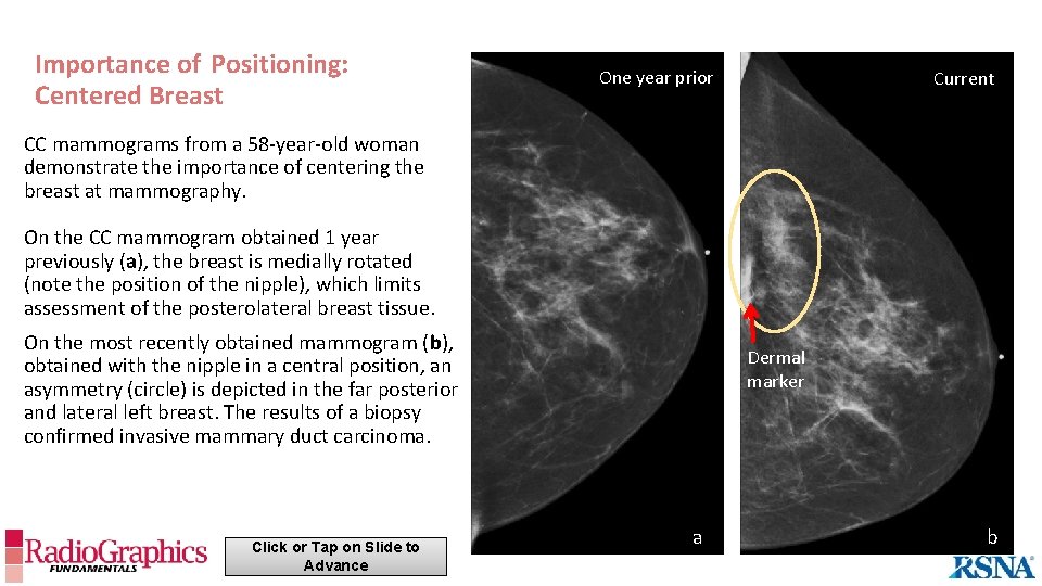 Interactive Casebased Review of Subtle Signs of Breast