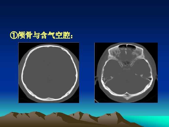 Brain and spinal cord Normal Appearance of Head