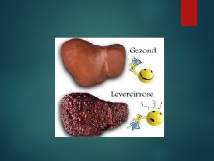 Hepatitis LEVERONTSTEKING oorzaken Virussen hepatitis A B C