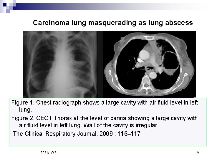 The imaging diagnosis of lung abscess 20211021 1