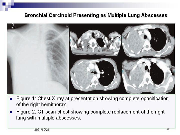The imaging diagnosis of lung abscess 20211021 1