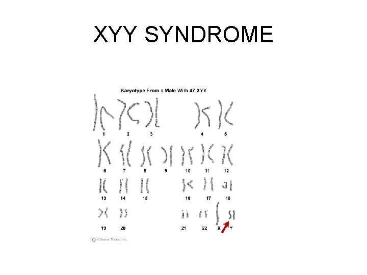 Karyotypes A picture of a persons chromosomes Karyotype