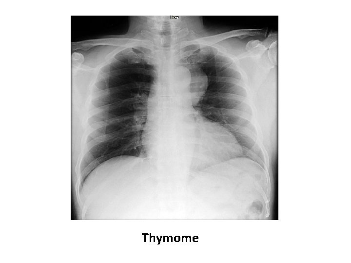 Pathologies du mdiastin Dr K Boussouf Matre assistant