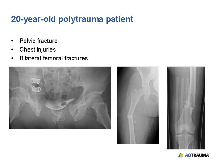Deep vein thrombosis moderated interactive session AOTrauma Advances