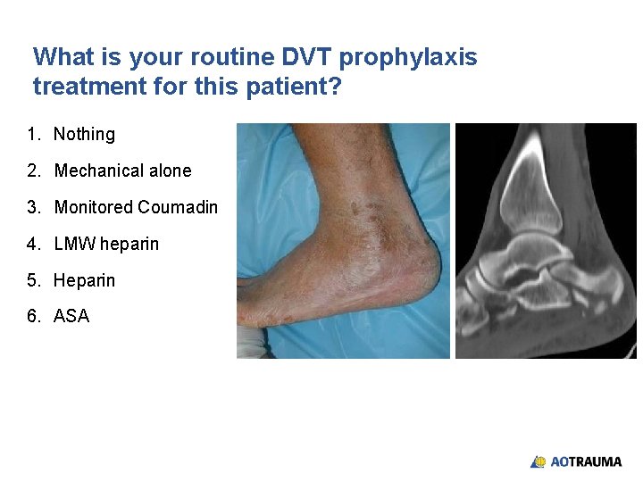 Deep vein thrombosis moderated interactive session AOTrauma Advances