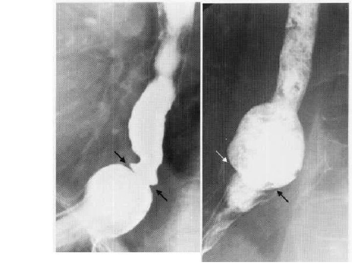 Barium Studies for Oesophagus Anatomy of Oesophagus 25