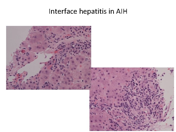 Liver Pathology Made Easy and Understandable II Patterns