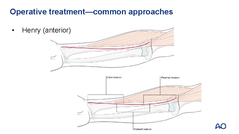 Forearm fracturesunderstanding the principles of diaphyseal and articular