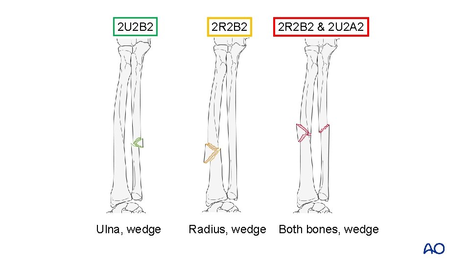 Forearm fracturesunderstanding the principles of diaphyseal and articular
