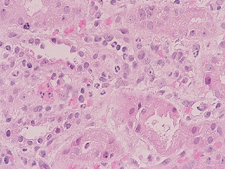 Update The Banff Schema for Renal Allograft Rejection