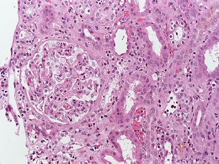 Update The Banff Schema for Renal Allograft Rejection
