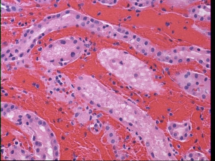 Update The Banff Schema for Renal Allograft Rejection