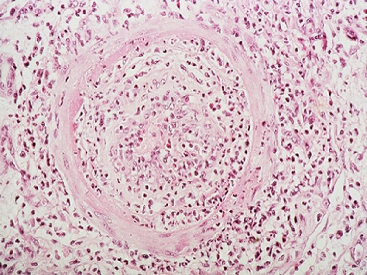 Update The Banff Schema for Renal Allograft Rejection