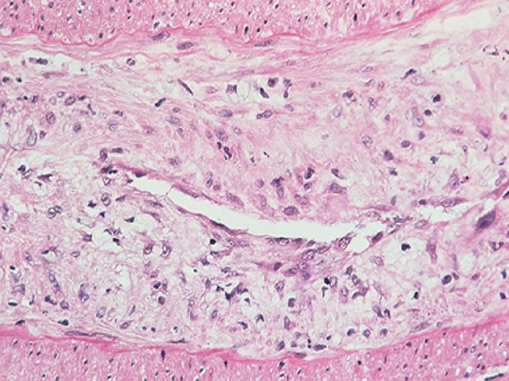 Update The Banff Schema for Renal Allograft Rejection