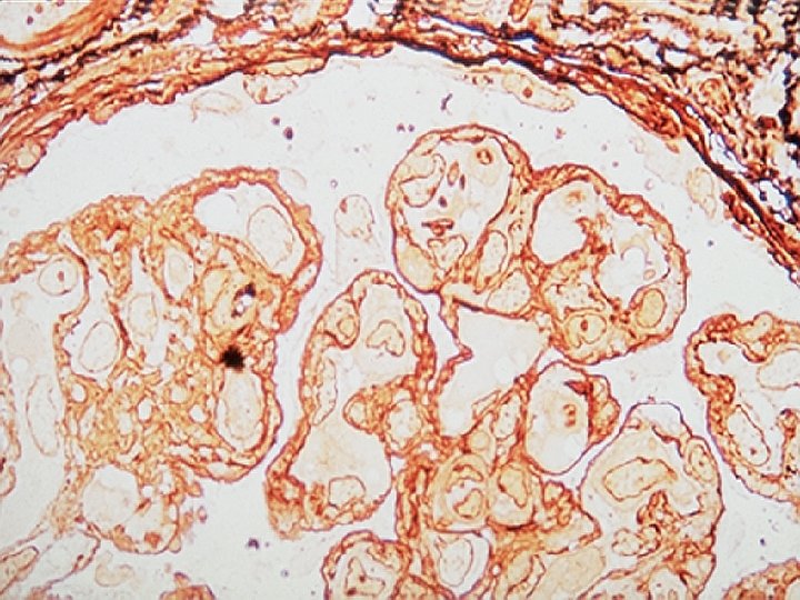 Update The Banff Schema for Renal Allograft Rejection