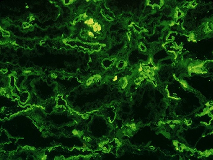 Update The Banff Schema for Renal Allograft Rejection