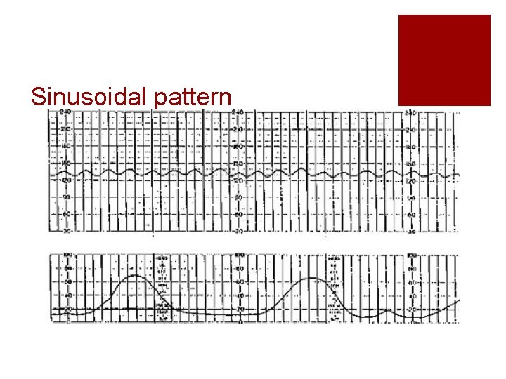 Electronic Fetal Heart Rate Monitoring AKA reading strips