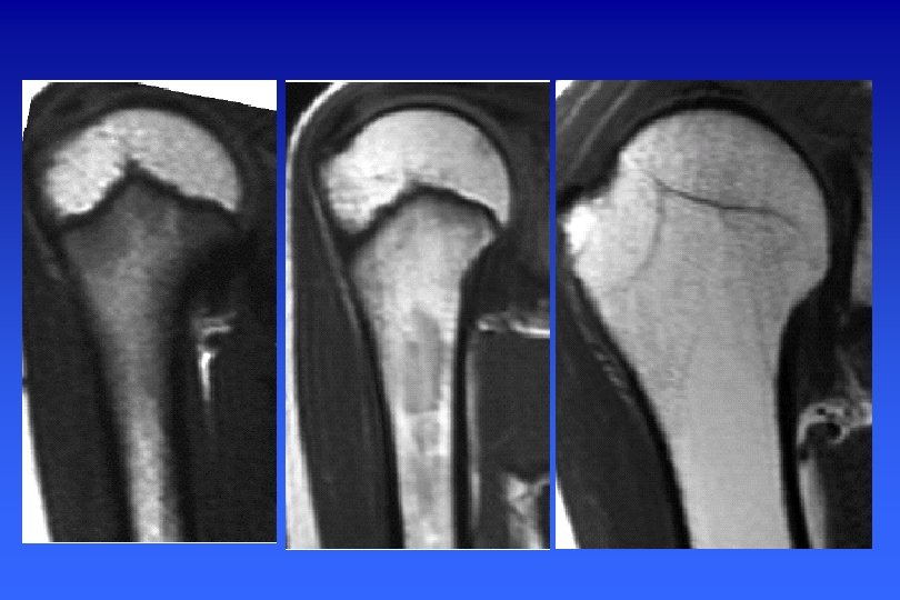 IMAGERIE DE LA MOELLE OSSEUSE DEFINITONS LEVOLUTION IRM